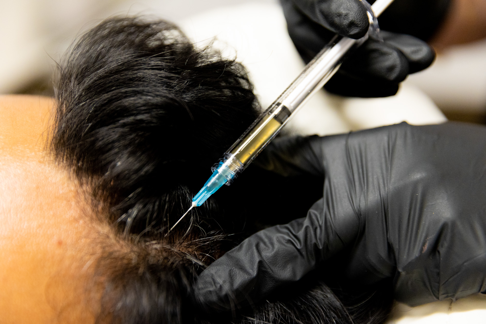 Hair Restoration in Carmel | Renova Aesthetics