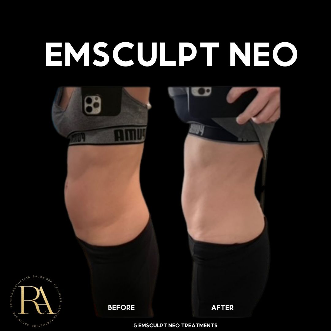 Emsculpt treatment review from InStyle! - Renova Aesthetics